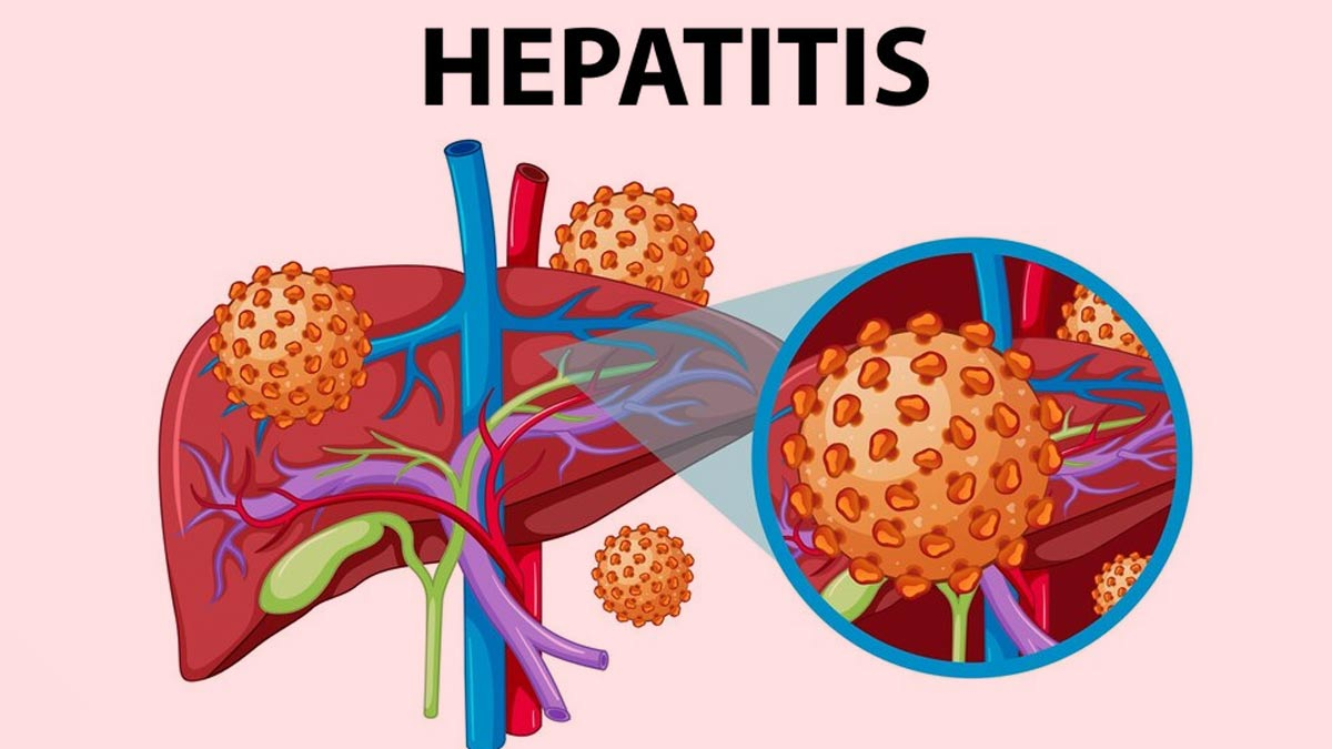 Hepatitis: Pathophysiology and Treatment - Pharmaacademias